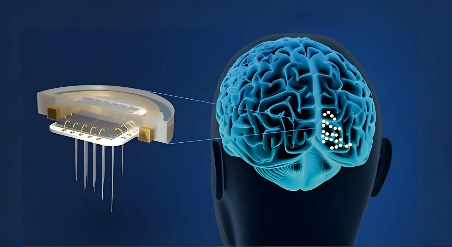 Revolutionary Wireless Visual Prosthesis Brain Implant Marks Two Years ... Revolutionary Wireless Visual Prosthesis Brain Implant Marks Two Years ...